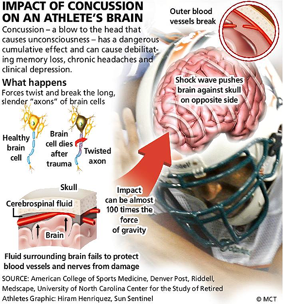 Concussions Still Loom as Major Issue for football, NFL – www ...